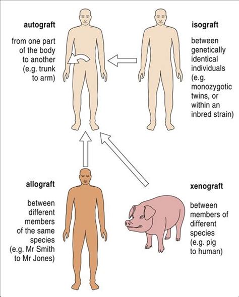 Transplantation Oncohema Key