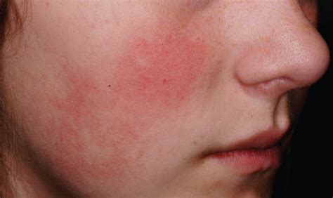 Erythema Face Causes