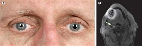 Horners Syndrome—not To Be Sneezed At The Lancet