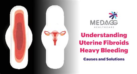 Uterine Fibroids Heavy Bleeding Causes And Solutions Medagg