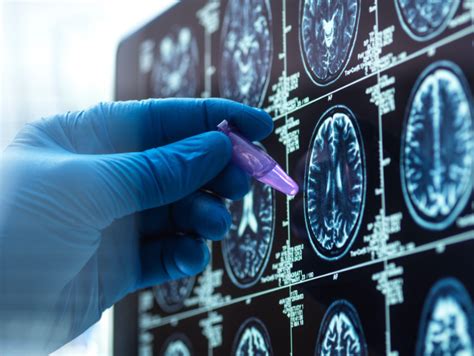 Cassava Sciences Halts Alzheimers Drug Trial After Limited Cphi Online