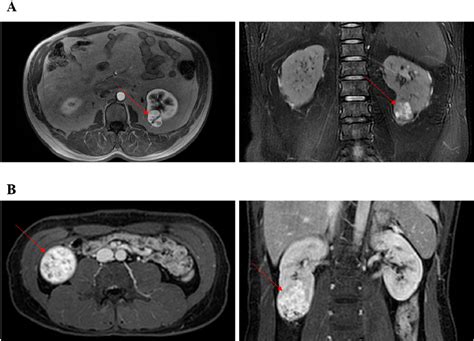 Figure 1 From Comparison Of Transperitoneal And Retroperitoneal Robotic