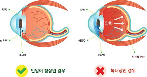 녹내장초기증상 녹내장검사 치료방법 녹내장수술 A2