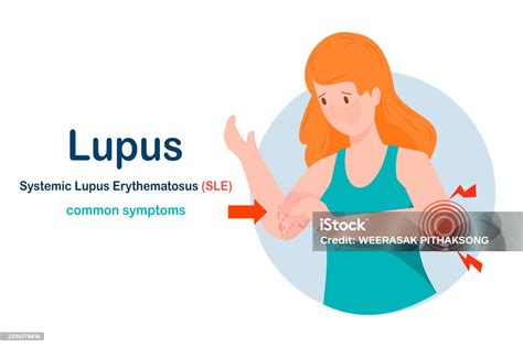 Common Symptoms Of Sle Stock Illustration Download Image Now Adult