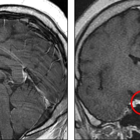 Pdf Combined Pituitary Hormone Deficiency Harboring Chd7 Gene