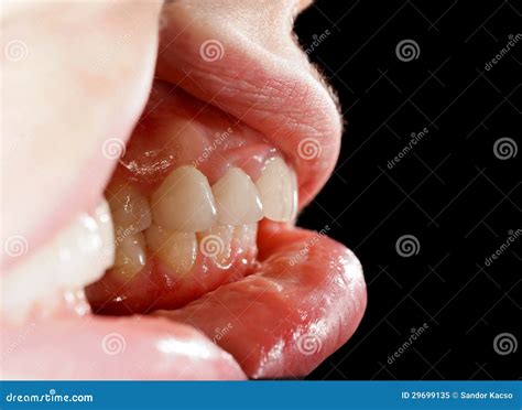 Abstract Teeth Stock Image Image Of Dentistry Prosthesis 29699135