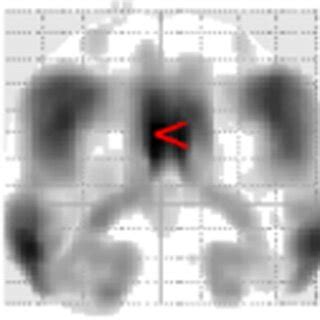 Sample Output Of SPM12 A Group Wise Comparison Was Performed On