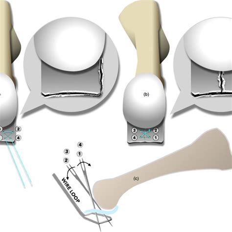 A B Sutures And Suture Loops Were Passed To The Plantar Side C As The