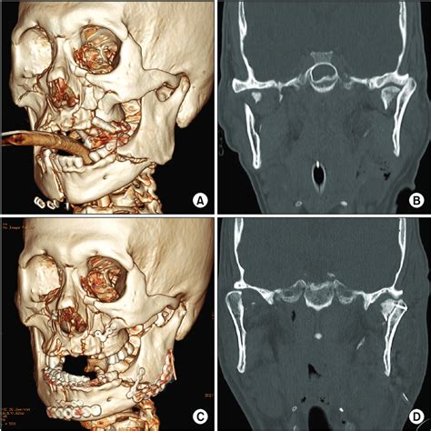 Mandibular Fossa Definition Location Function Fracture