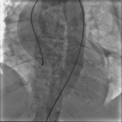 Journal Of Invasive Cardiology On Linkedin February Clinical Image Ascending Aortic Rupture