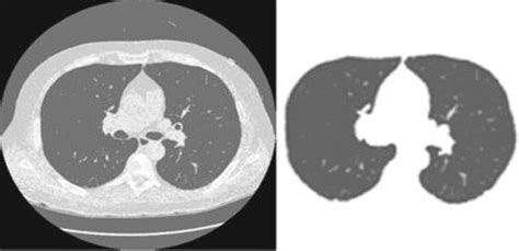 Figure 2 1 From Lung Nodule Detection And Segmentation Using A Patch Based Multi Atlas Method