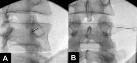 Medial Branch Block Procedure Allspine