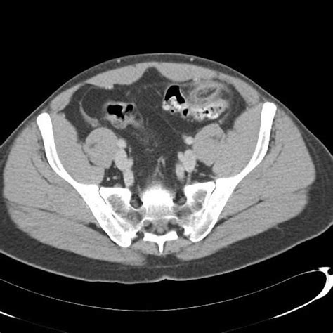 Epiploic Appendagitis Radiology Case Radiology Diverticulitis Pathology