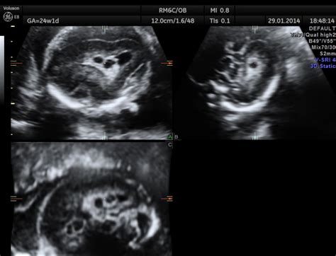 Isolated Choroid Plexus Cyst Looking Through A Transducer