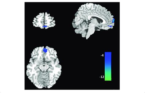 Difference In Functional Connectivity Of The Default Mode Network Download Scientific Diagram