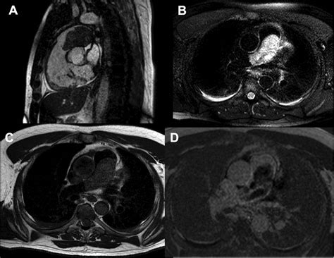 Pulmonary Artery Intimal Sarcoma Masquerading As Pulmonary Embolism Circulation