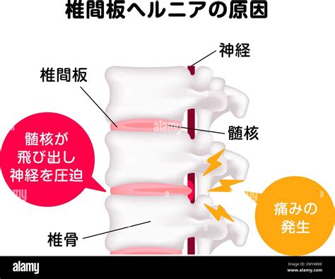 Spinal Disc Herniation Vector Illustration Stock Vector Image And Art Alamy
