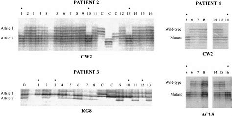 Analysis Of Microsatellite Markers On Chromosome 16p133 In Different