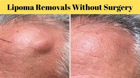 Lipoma Removal