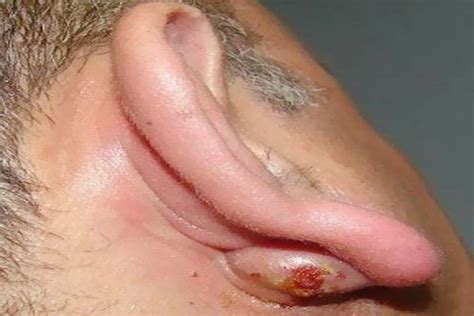Tips To Get Rid Of Pimple In Earlobe