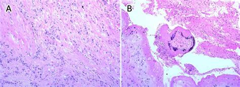 A Histologic Findings From The Resected Specimen Hande X 200 Download Scientific Diagram