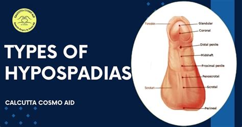 Types Of Hypospadias Explained In 5 Simple Steps