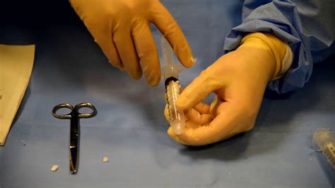 Eus Guided Treatment Of Gastric Varices With Coil Embolization And