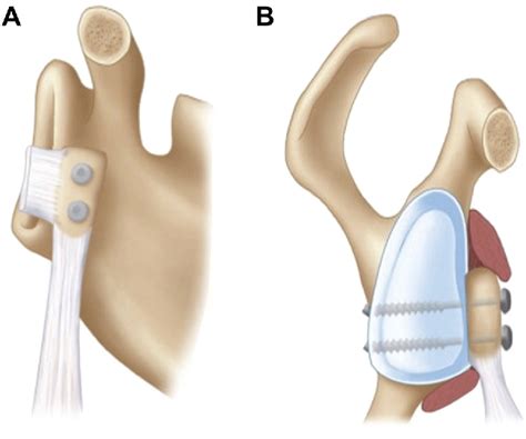Figure 1 From The Outcomes And Surgical Techniques Of The Latarjet