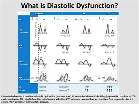 Ppt Diastolic Dysfunction As Diagnosed And Quantified By Echocardiography Powerpoint