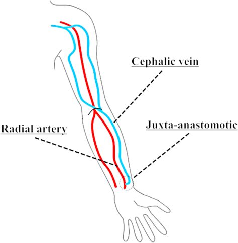 Fistuloplasty