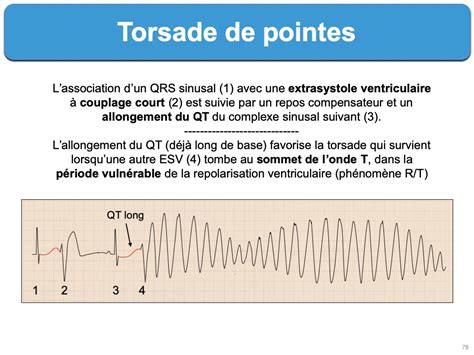 Torsades De Pointes E Cardiogram