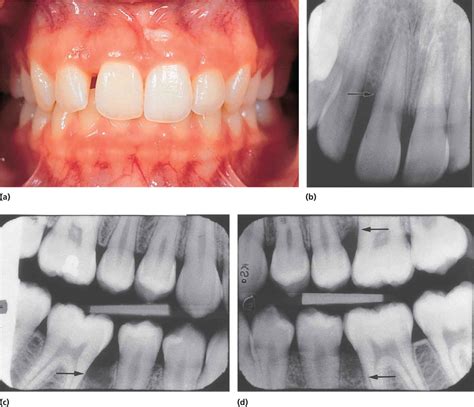 14 Periodontal Conditions Pocket Dentistry