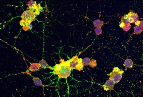 Cow S Milk May Exacerbate Multiple Sclerosis Symptoms BioNews Central