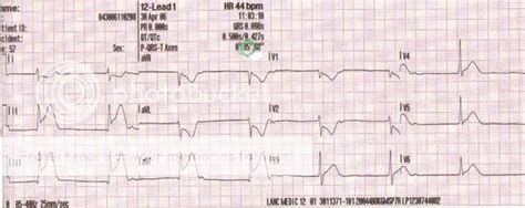 Left And Right Axis Deviation Emtlife