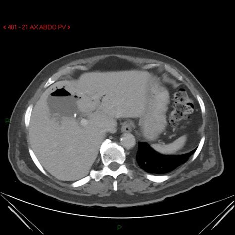 Radiopaedia Case Gallbladder Fossa Abscess Id 41444 Study 44327 Nc