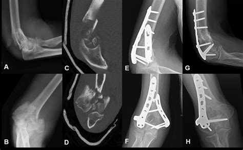 An 83 Year Old Female Sustained A Comminuted Intra Articular Distal Download Scientific Diagram