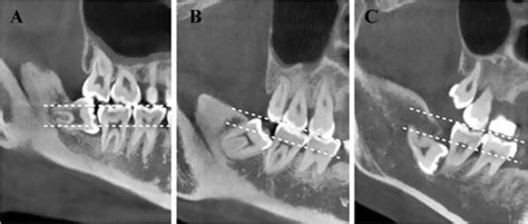 The Pell Gregory Classification Of Impacted Mandibular Third Molars