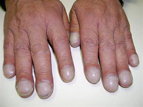 Finger Clubbing And Lung Cancer Gatewayc
