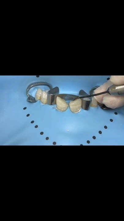 부러진 앞니 다시 붙이기 Youtube