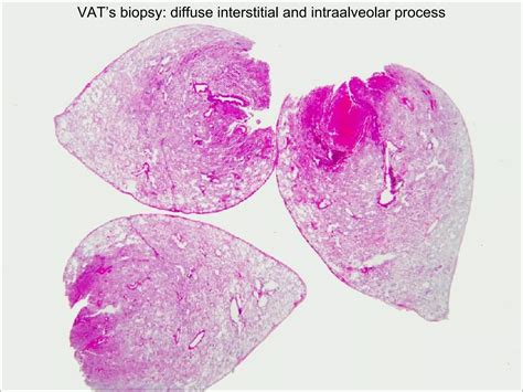 Diffuse Alveolar Damage Ppt
