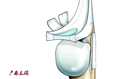 超高清动图讲解三角纤维软骨复合体损伤，满分干货好文！ 好医术文章 好医术 赋能医生守护生命