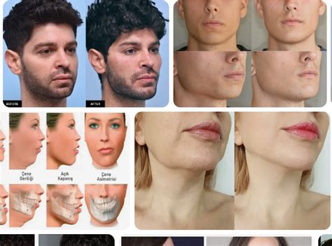 Jawline Dolgusu Nedir Jawline Dolgusu Nas L Yap L R