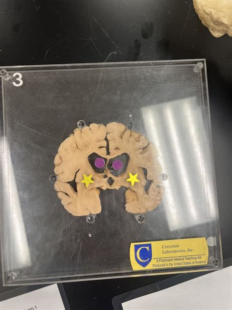 Inside Coronal Cut Of Brain Diagram Quizlet