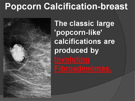 Popcorn Calcification Breast Radiology Classroom