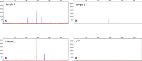 A D Genescan Based Fragment Length Analysis Of Flt3 Itd Mutation Was Download Scientific