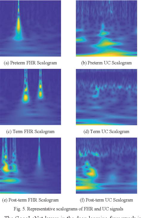 Figure 2 From Automated Classification Of Ctg Signals Using Deep Learning Based Scalogram