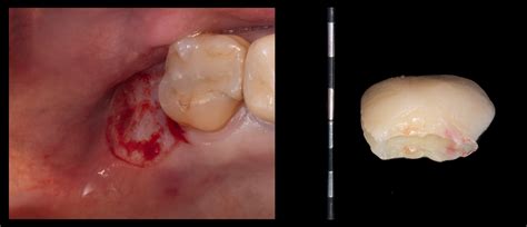 Autogenous Connective Tissue Grafts Biological And Technical Considerations Lefildentaire