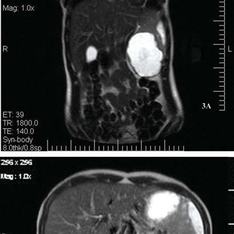 Ulcerative Pyoderma Gangrenosum Fig 2 Bullous Pyoderma Gangrenosum