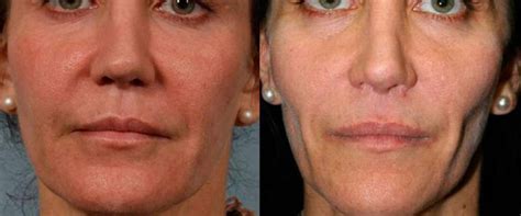 Are Facial Fillers Permanent A Comprehensive Guide