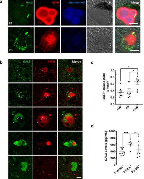 Galectin 3 Gal3 Is Associated With Lewy Bodies Lb And Pale Bodies Download Scientific